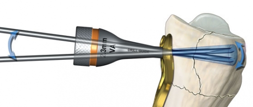 Acu Loc 2 Wrist Plating System Ortho Medics