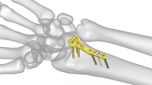 Acu Loc 2 Wrist Plating System Ortho Medics