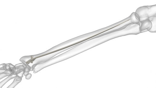 Forearm Rod System – Ortho Medics