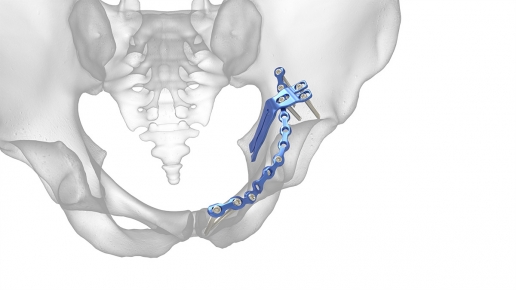 Acumed Pelvic Plating System – Ortho Medics